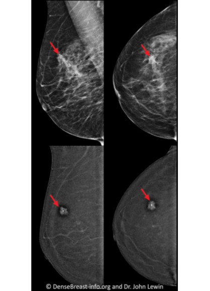 Contrast-Enhanced Mammography - Crouse Health