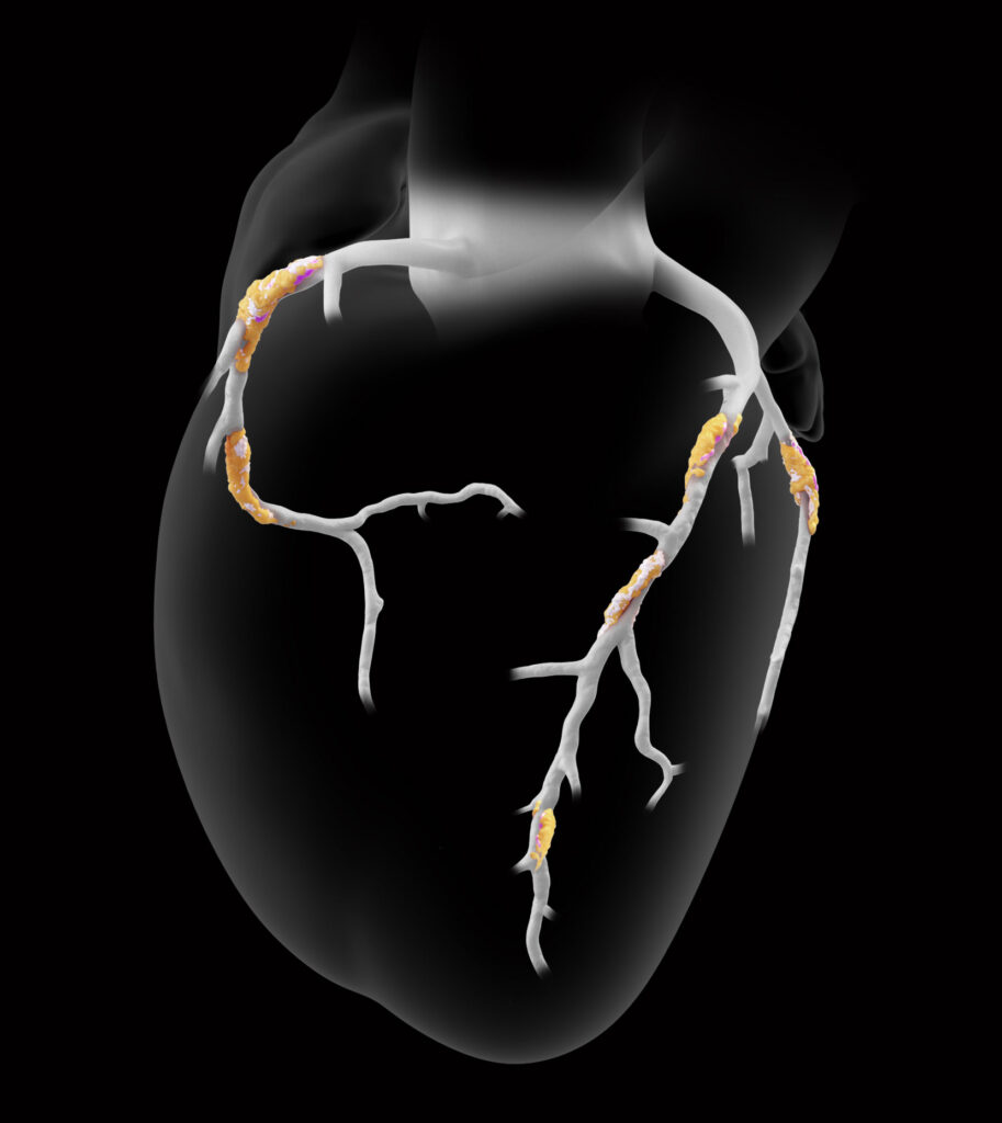 Crouse Health Announces Availability of Heartflow Analysis to Enhance ...